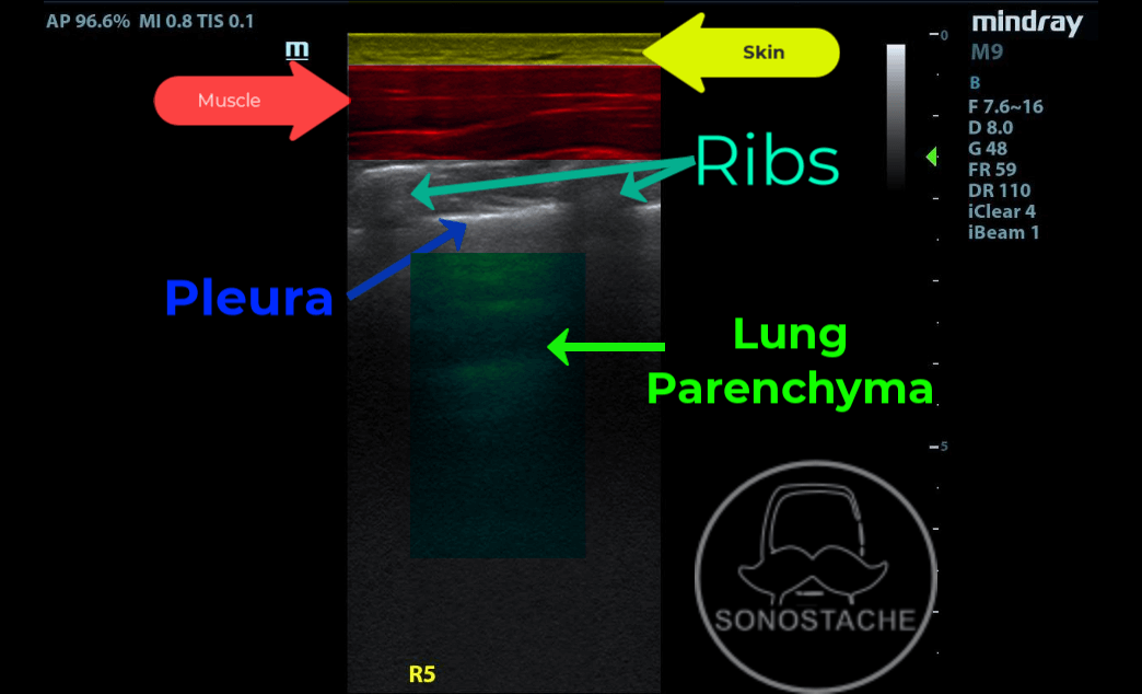 Pulmonary Ultrasound - Sonostache